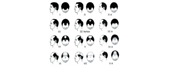 What is Hair Loss | Hair Loss | Toronto Hair Transplant Centre